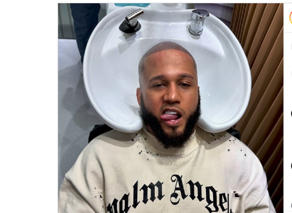 El Alfa cantante de música urbana causa impacto por implantes de cabello